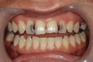 La caries dental by Iván Gómez - Infogram